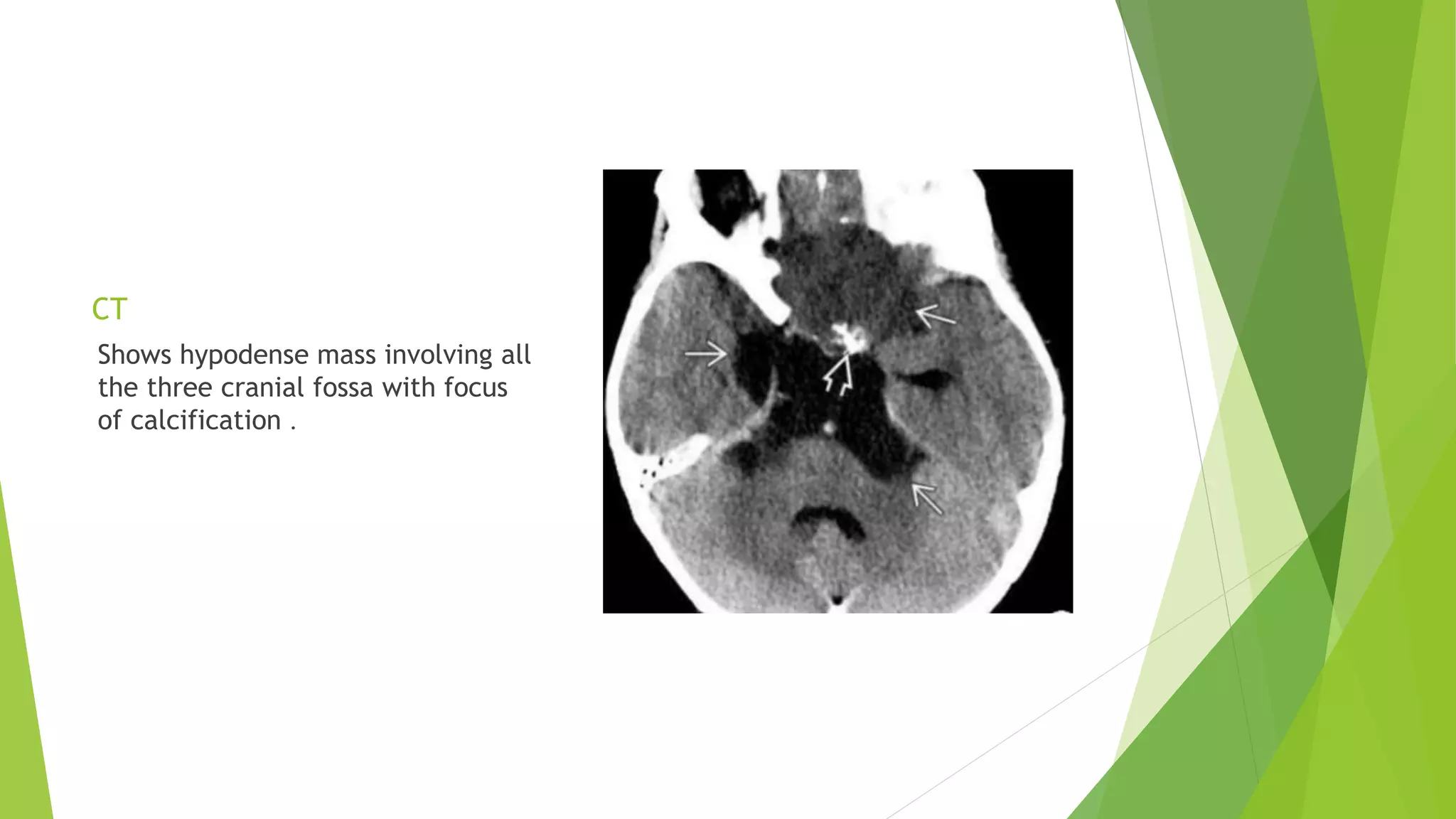IMAGING OF SELLA AND SELLAR LESIONS MONICA.pptx