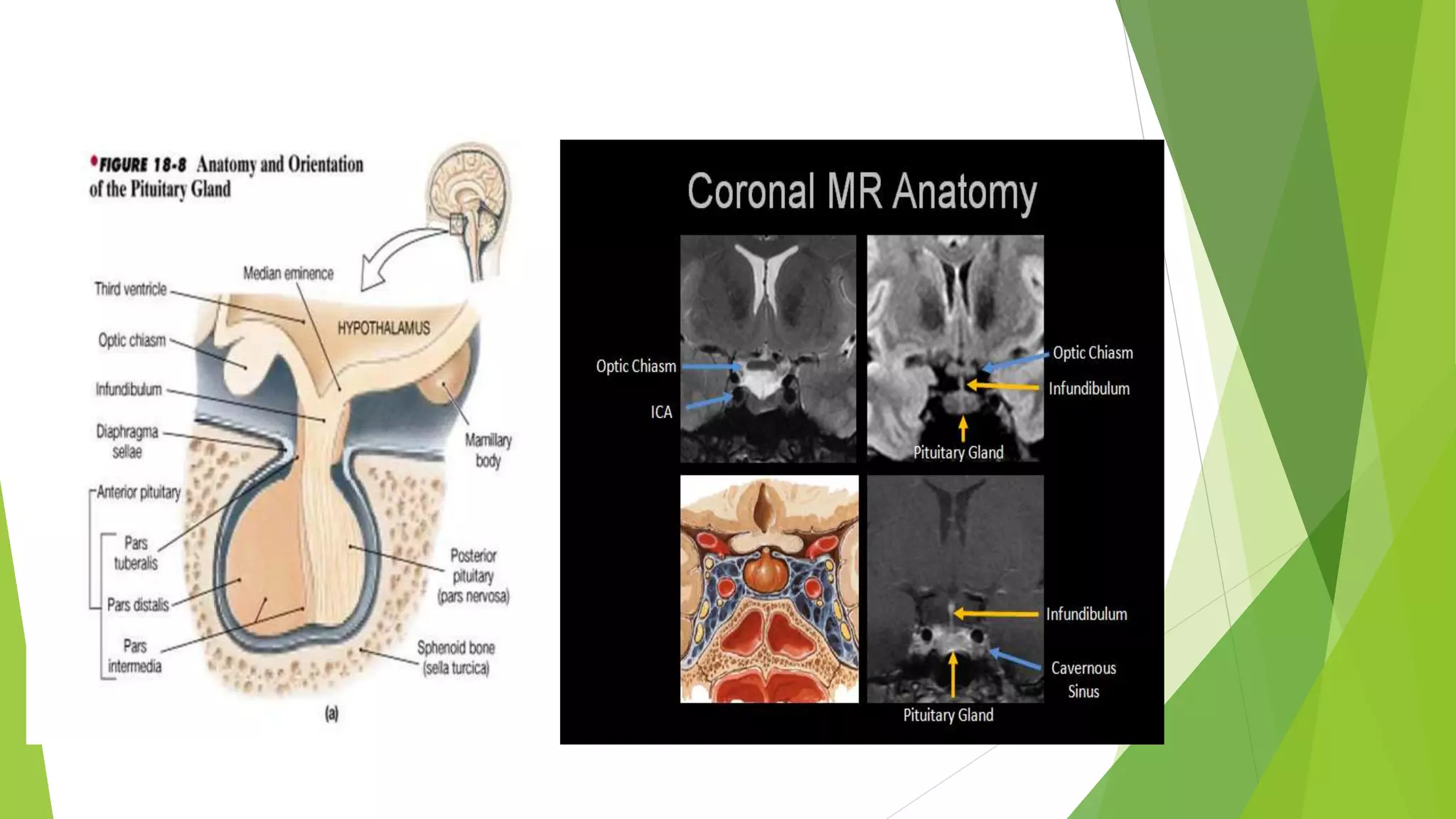 IMAGING OF SELLA AND SELLAR LESIONS MONICA.pptx