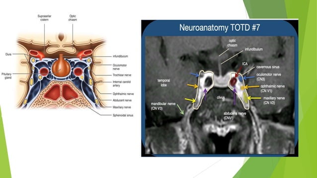 IMAGING OF SELLA AND SELLAR LESIONS MONICA.pptx | Endocrine and ...