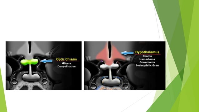 IMAGING OF SELLA AND SELLAR LESIONS MONICA.pptx | Endocrine and ...