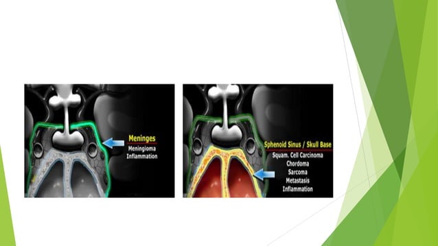 IMAGING OF SELLA AND SELLAR LESIONS MONICA.pptx | Endocrine and ...