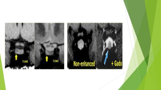 IMAGING OF SELLA AND SELLAR LESIONS MONICA.pptx | Endocrine and ...