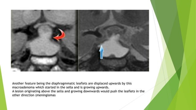 IMAGING OF SELLA AND SELLAR LESIONS MONICA.pptx | Endocrine and ...