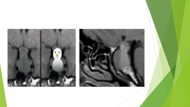 IMAGING OF SELLA AND SELLAR LESIONS MONICA.pptx | Endocrine and ...