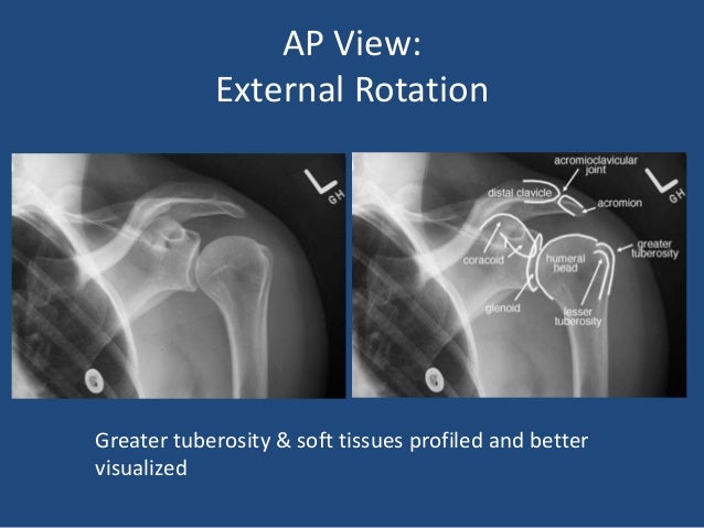 Imaging of shoulder - Dr. Vishal Sankpal