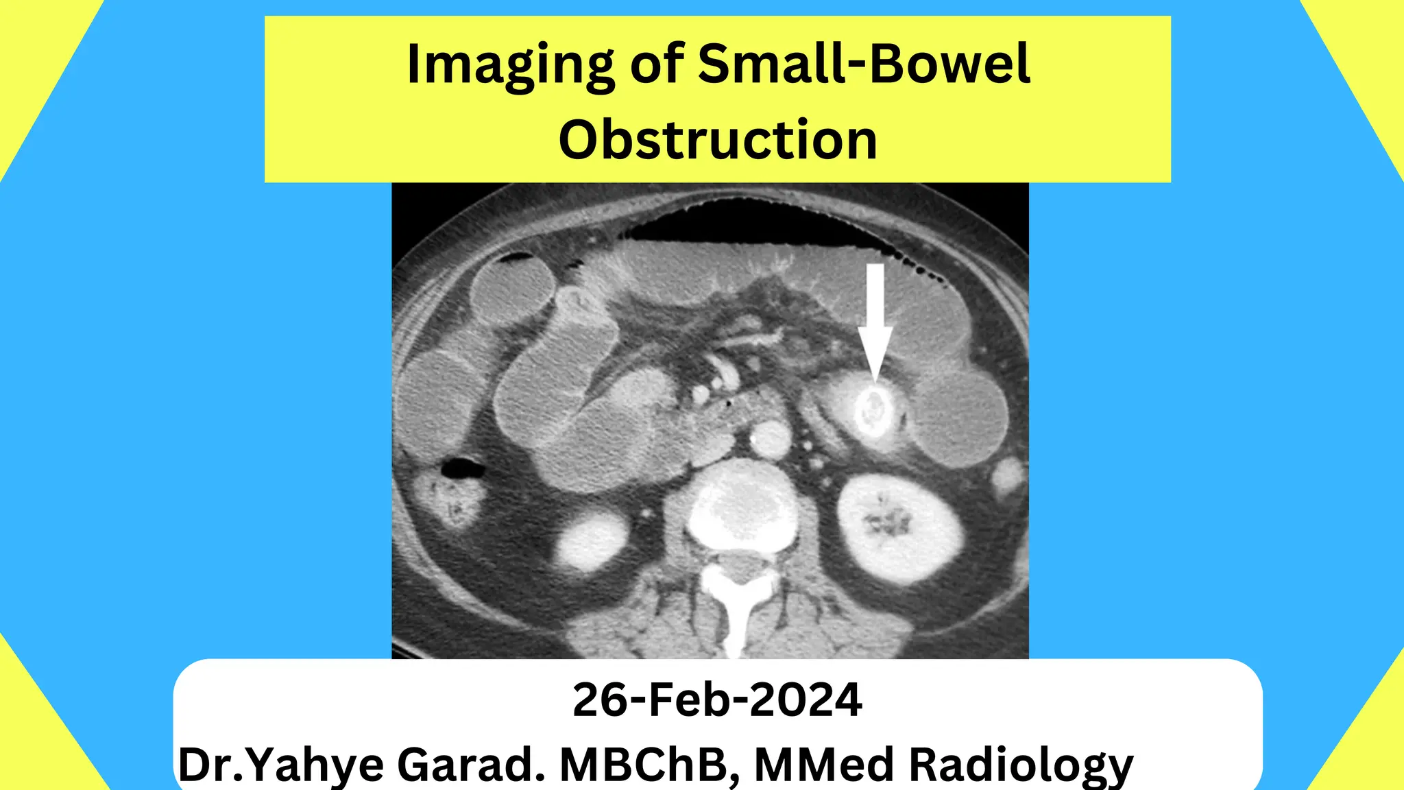 Radiological Imaging of Small-Bowel Obstruction | PDF