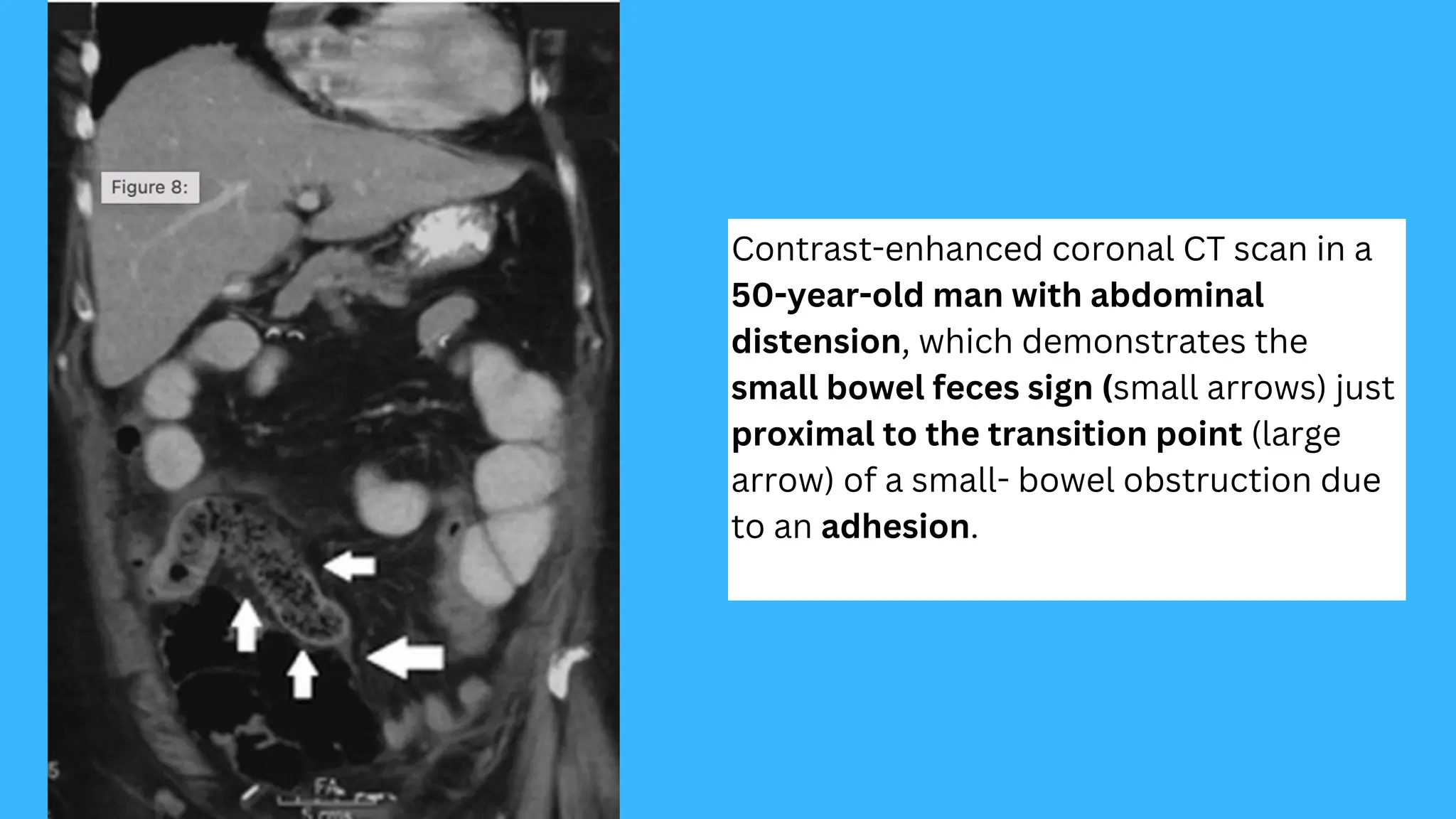 Radiological Imaging of Small-Bowel Obstruction | PDF