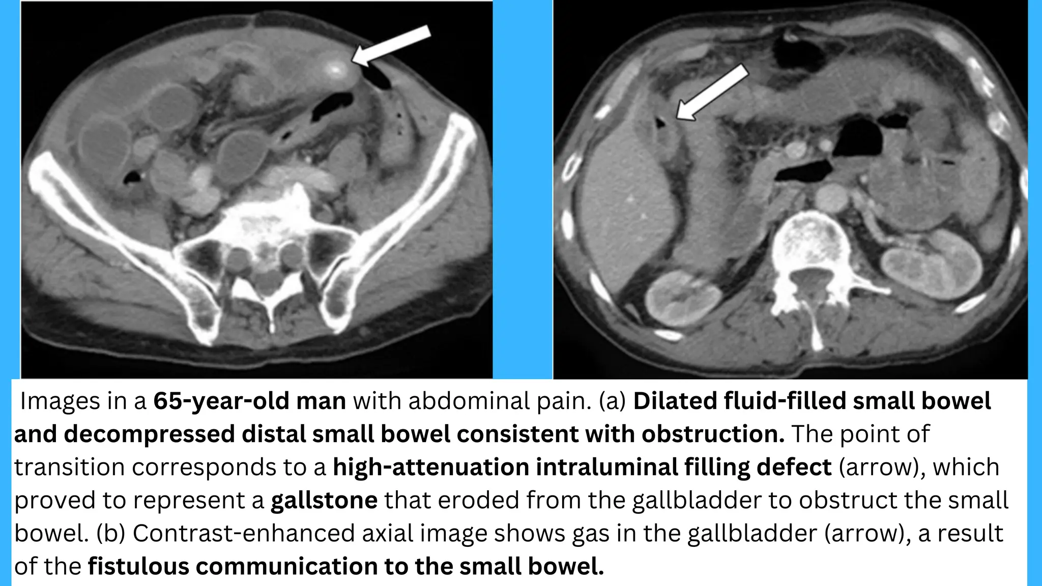 Radiological Imaging of Small-Bowel Obstruction | PDF