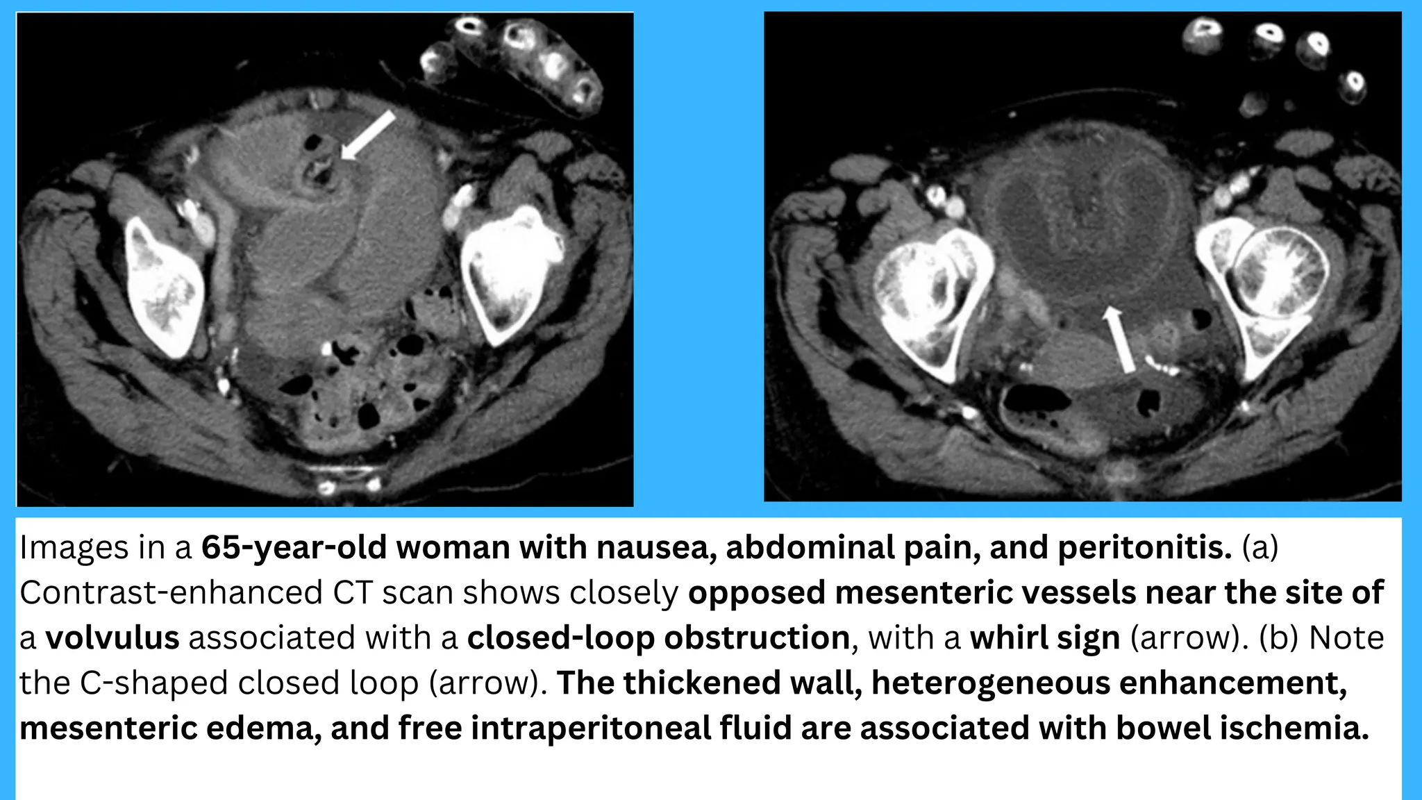 Radiological Imaging of Small-Bowel Obstruction | PDF