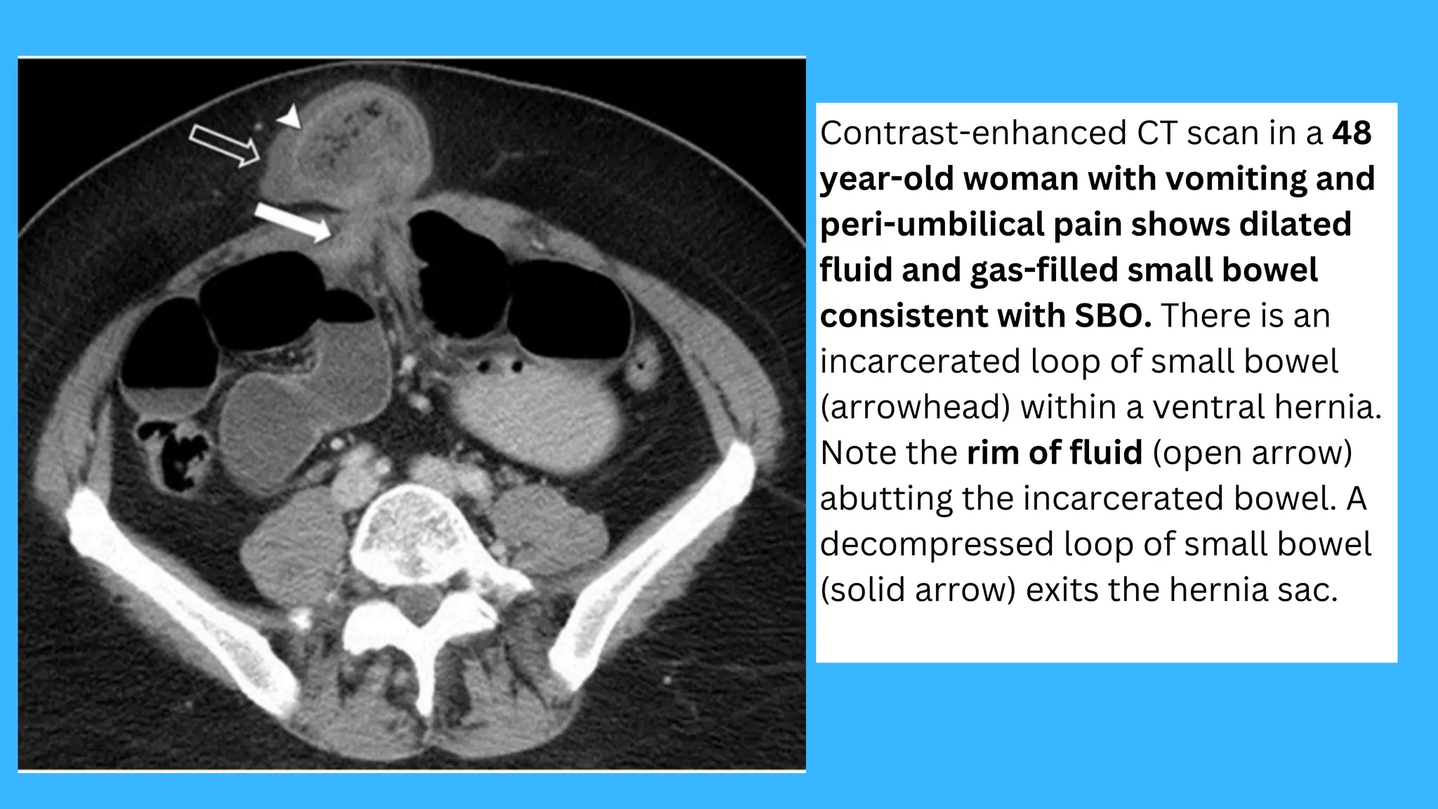 Radiological Imaging of Small-Bowel Obstruction | PDF