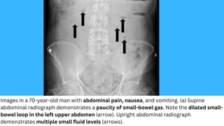 Radiological Imaging of Small-Bowel Obstruction | PDF
