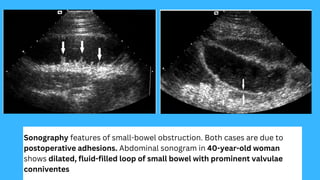 Radiological Imaging of Small-Bowel Obstruction | PDF