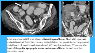 Radiological Imaging of Small-Bowel Obstruction | PDF