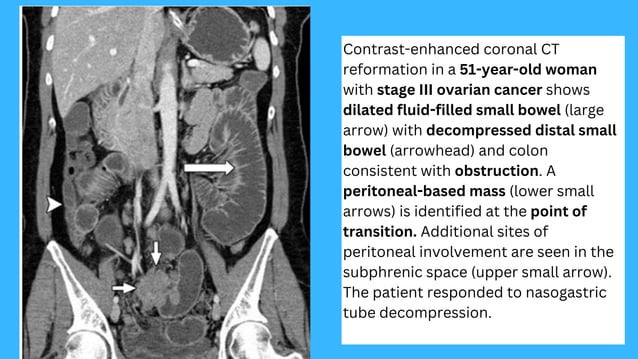 Radiological Imaging of Small-Bowel Obstruction | PDF | Digestive ...