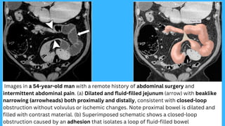 Radiological Imaging of Small-Bowel Obstruction | PDF