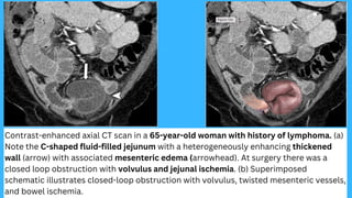 Radiological Imaging of Small-Bowel Obstruction | PDF