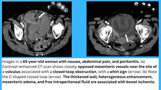 Radiological Imaging of Small-Bowel Obstruction | PDF