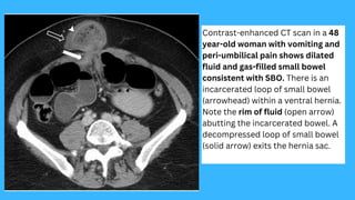 Radiological Imaging of Small-Bowel Obstruction | PDF