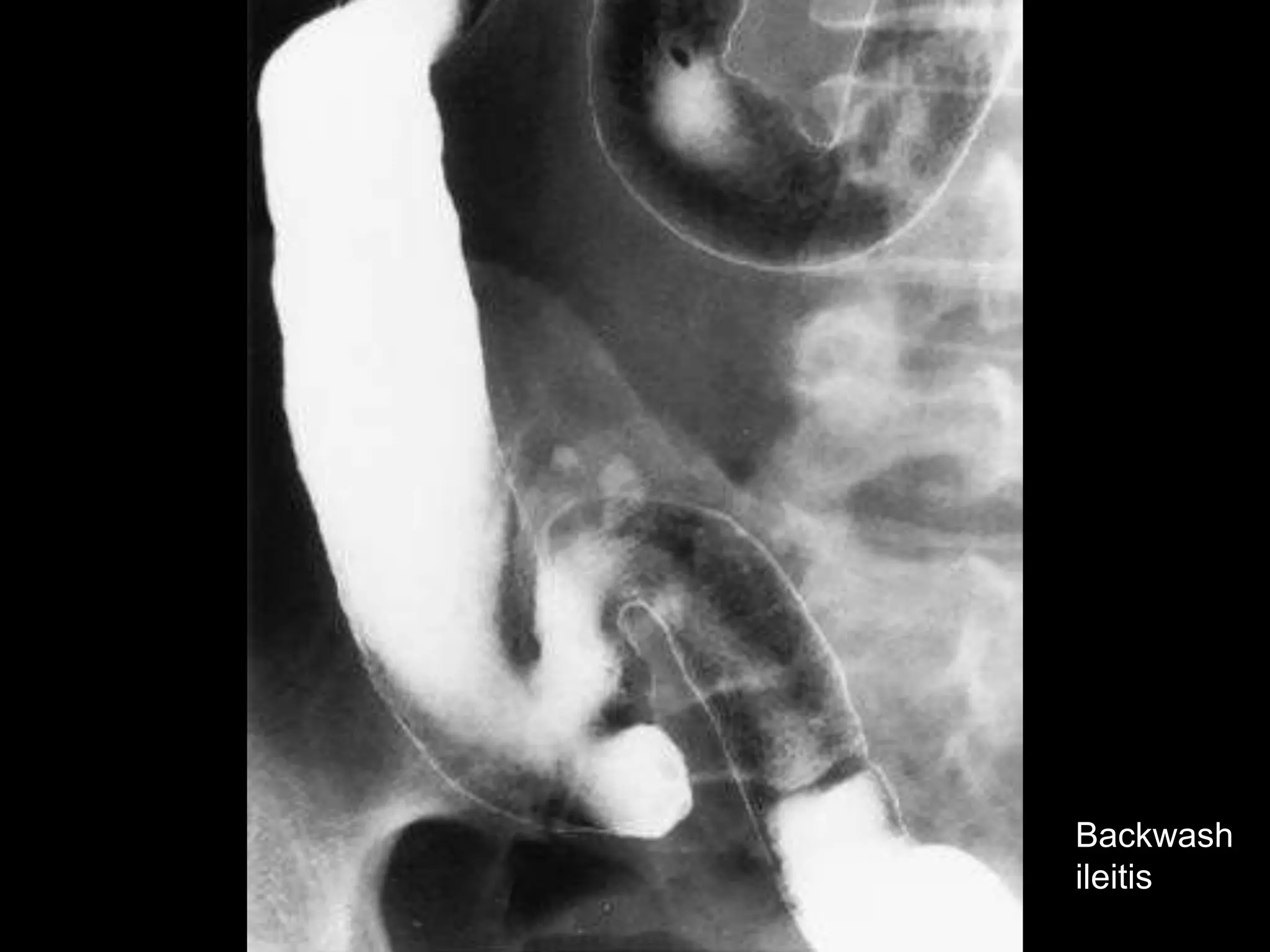 Imaging of small bowel pathologies | PPTX