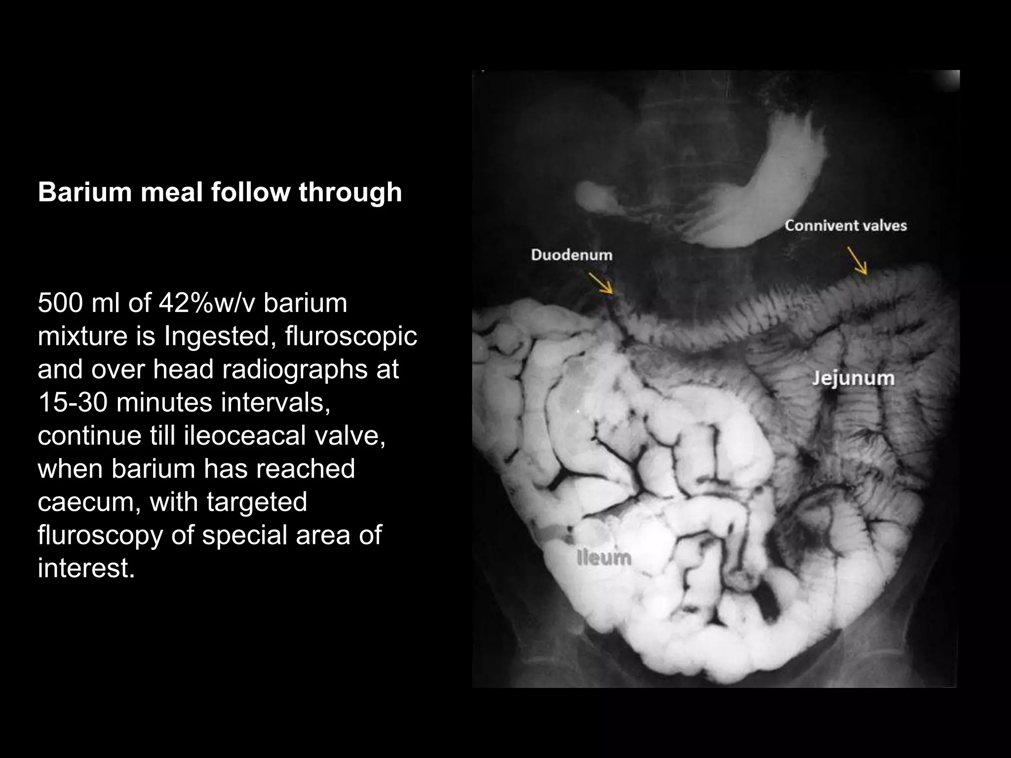 Imaging of small bowel pathologies | PPTX