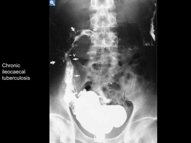Imaging of small bowel pathologies | PPTX