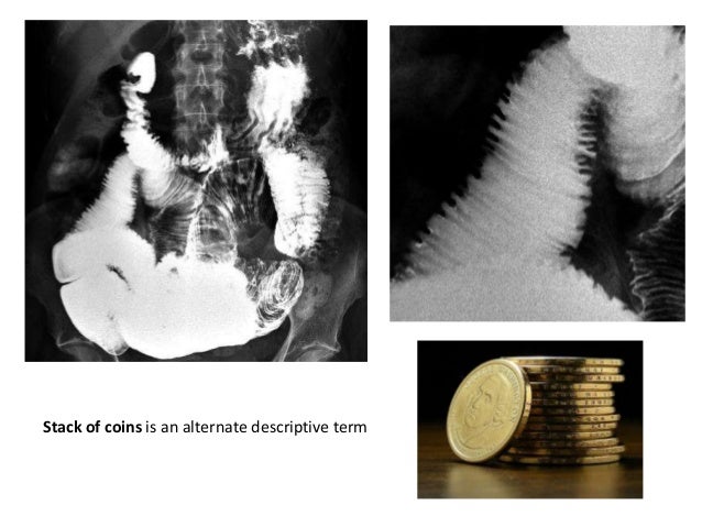 Imaging of small bowel pathology