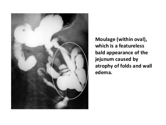 Imaging of small bowel pathology