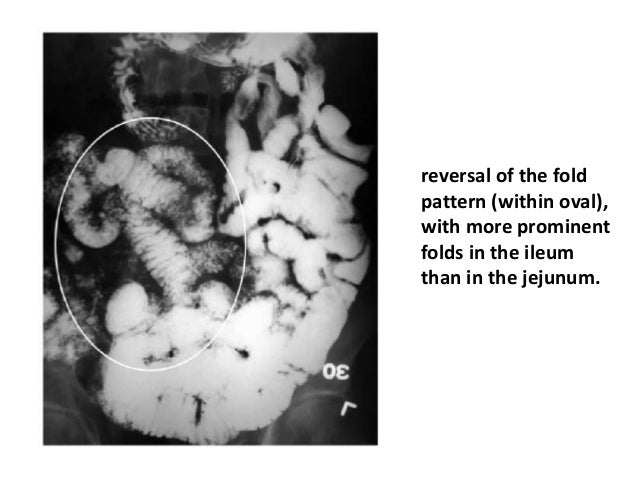 Imaging of small bowel pathology