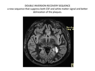 Imaging of spinal cord acute myelopathies | PPTX