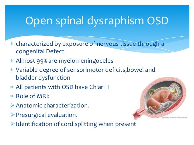 Imaging of spinal dysraphism
