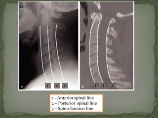 Imaging of spinal trauma | PPTX