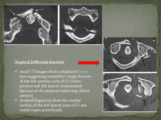 Imaging of spinal trauma | PPTX