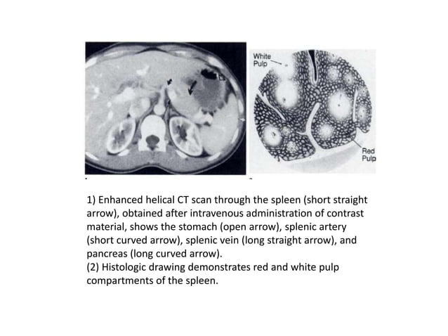 Imaging of spleen ct and mri | PPTX