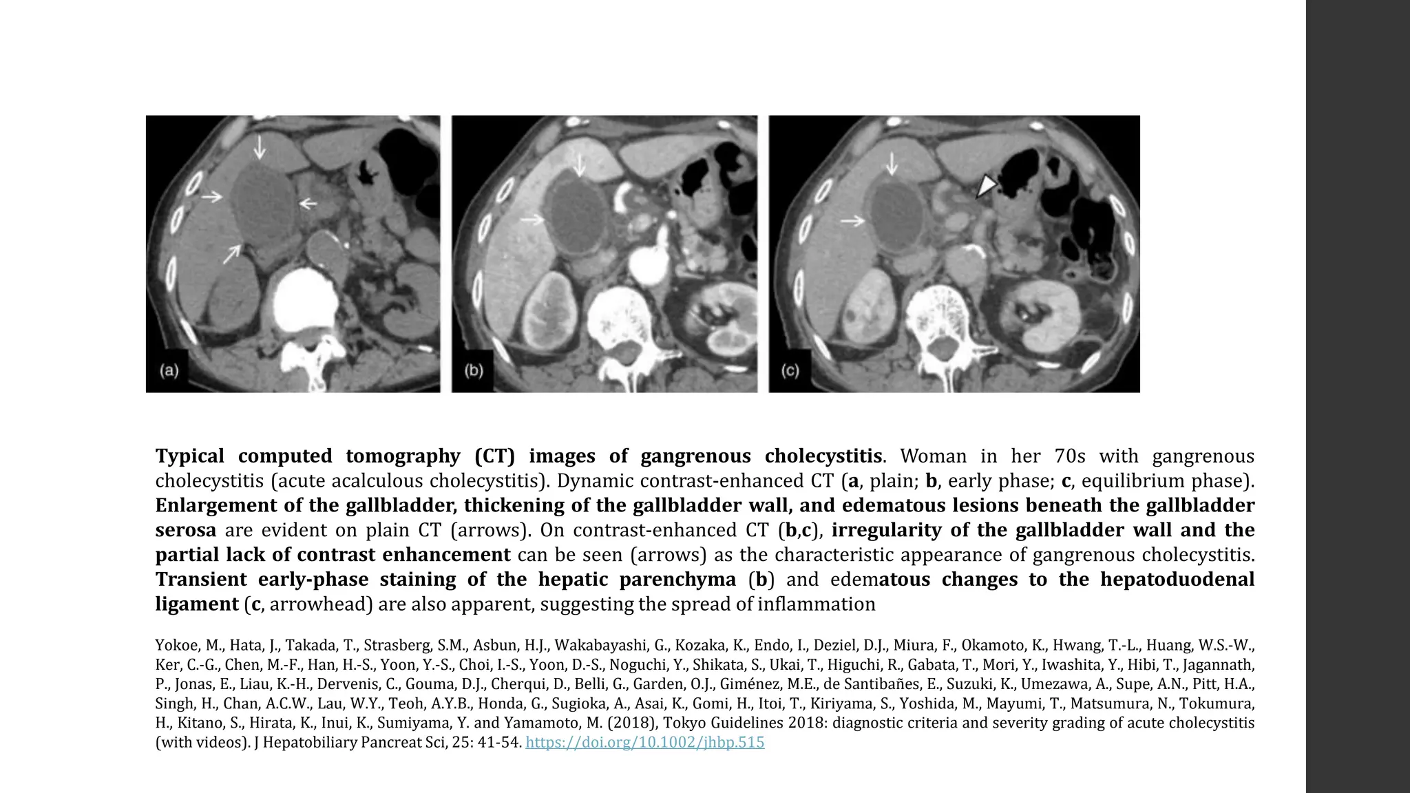 Imaging of Acute Abdomen | PPTX