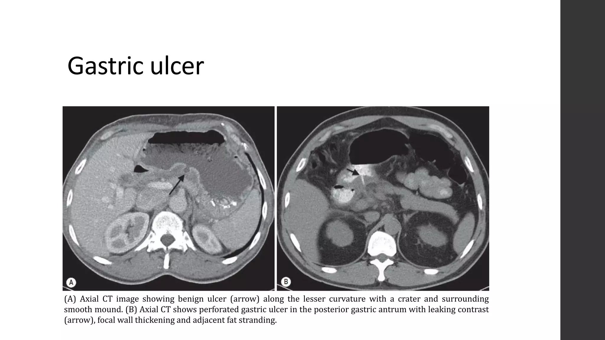 Imaging of Acute Abdomen | PPTX