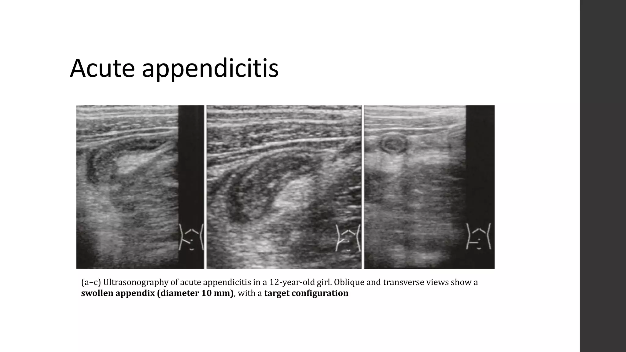 Imaging of Acute Abdomen | PPTX
