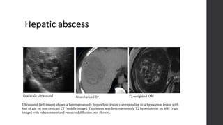 Imaging of Acute Abdomen | PPTX