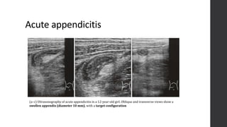 Imaging of Acute Abdomen | PPTX