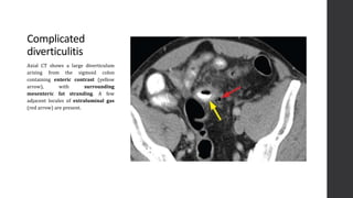 Imaging of Acute Abdomen | PPTX