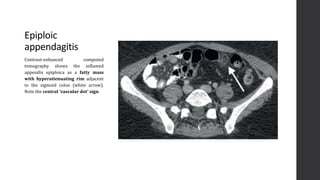 Imaging of Acute Abdomen | PPTX