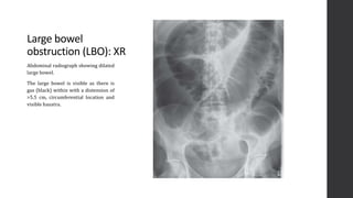 Imaging of Acute Abdomen | PPTX