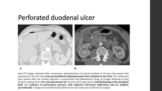 Imaging of Acute Abdomen | PPTX