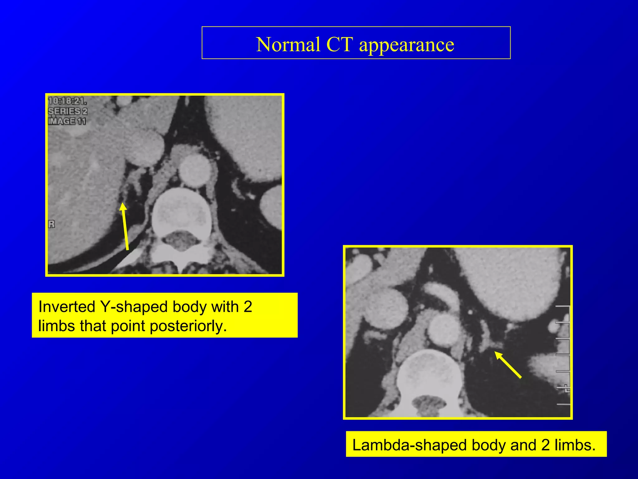 Imaging of the adrenal glands | PPT