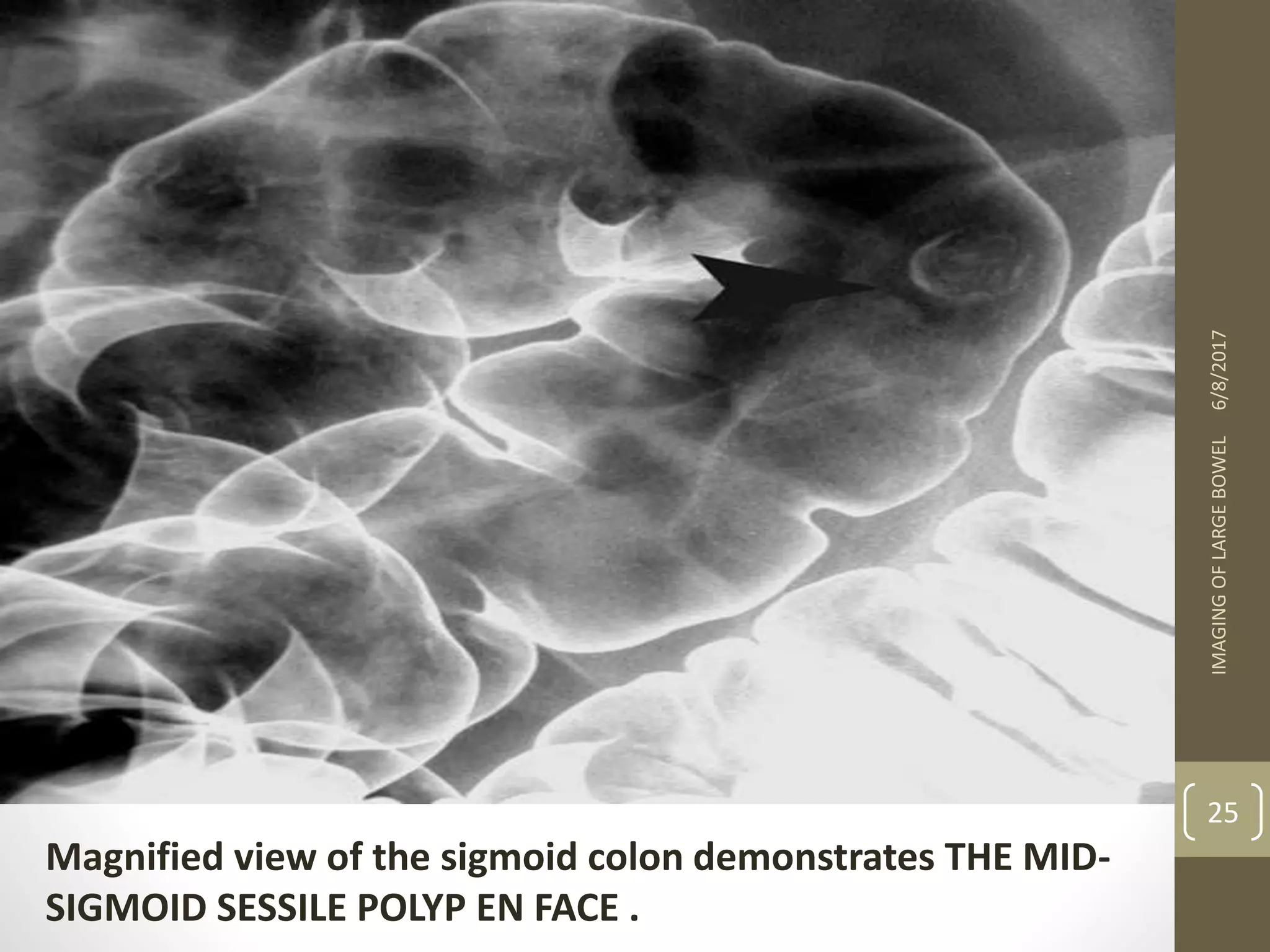 Imaging of the large bowel | PPTX