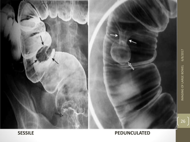 Imaging of the large bowel | PPTX | Digestive Disorders | Diseases and ...