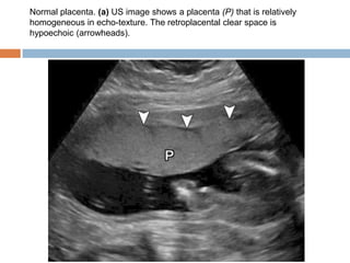 Imaging of the placenta | PPTX
