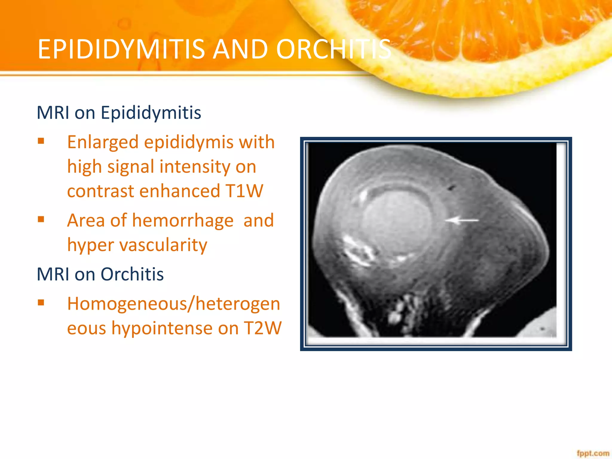 Imaging of the scrotum | PPTX