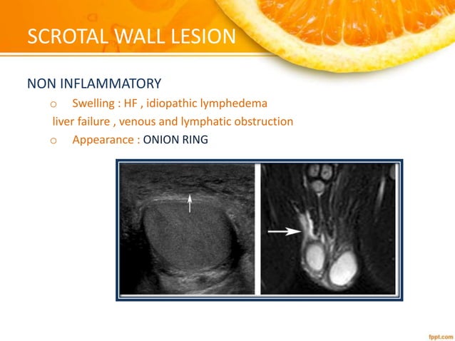 Imaging Of The Scrotum Ppt