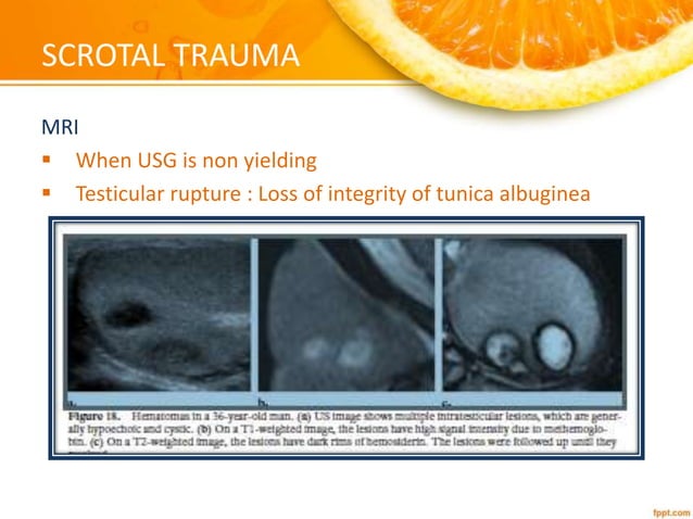 Imaging of the scrotum | PPTX