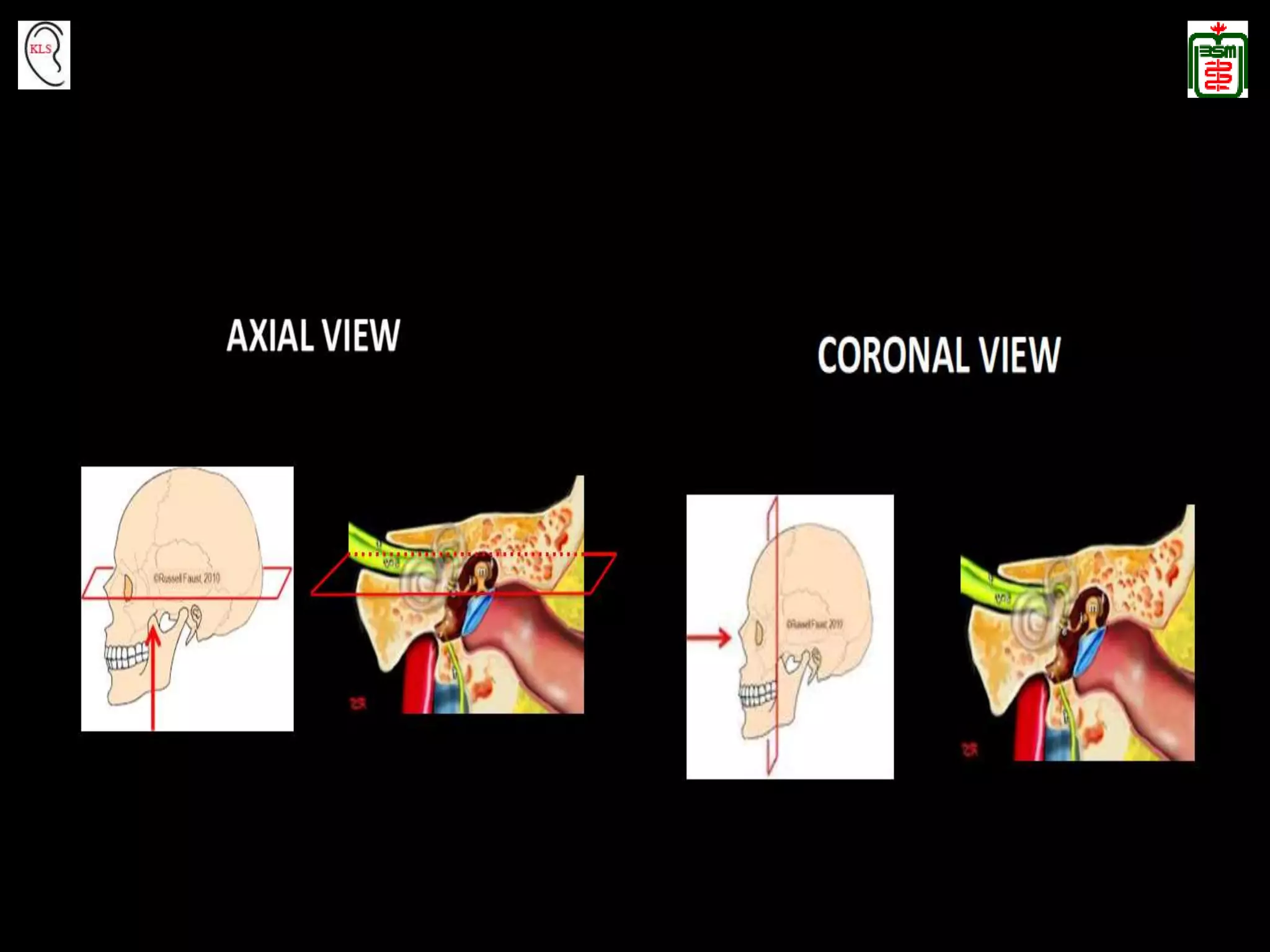 Imaging of the temporal bone | PPTX | Ear, Nose and Throat Conditions ...